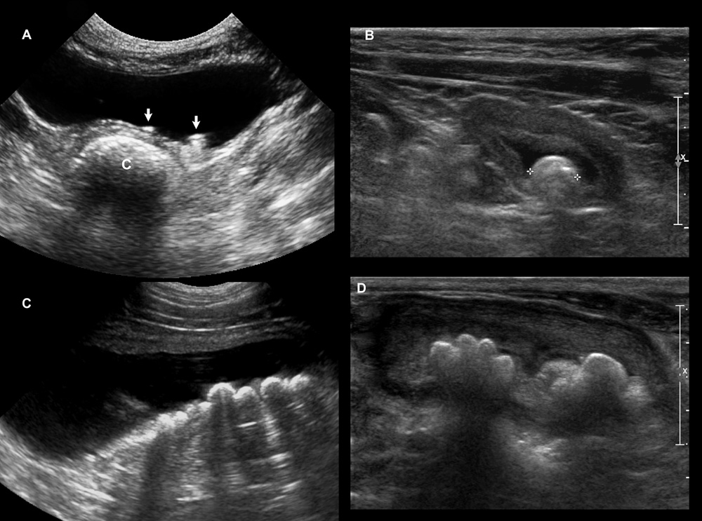 Idiopathic fat necrosis (Bate's body) - Small Animal Ultrasonography
