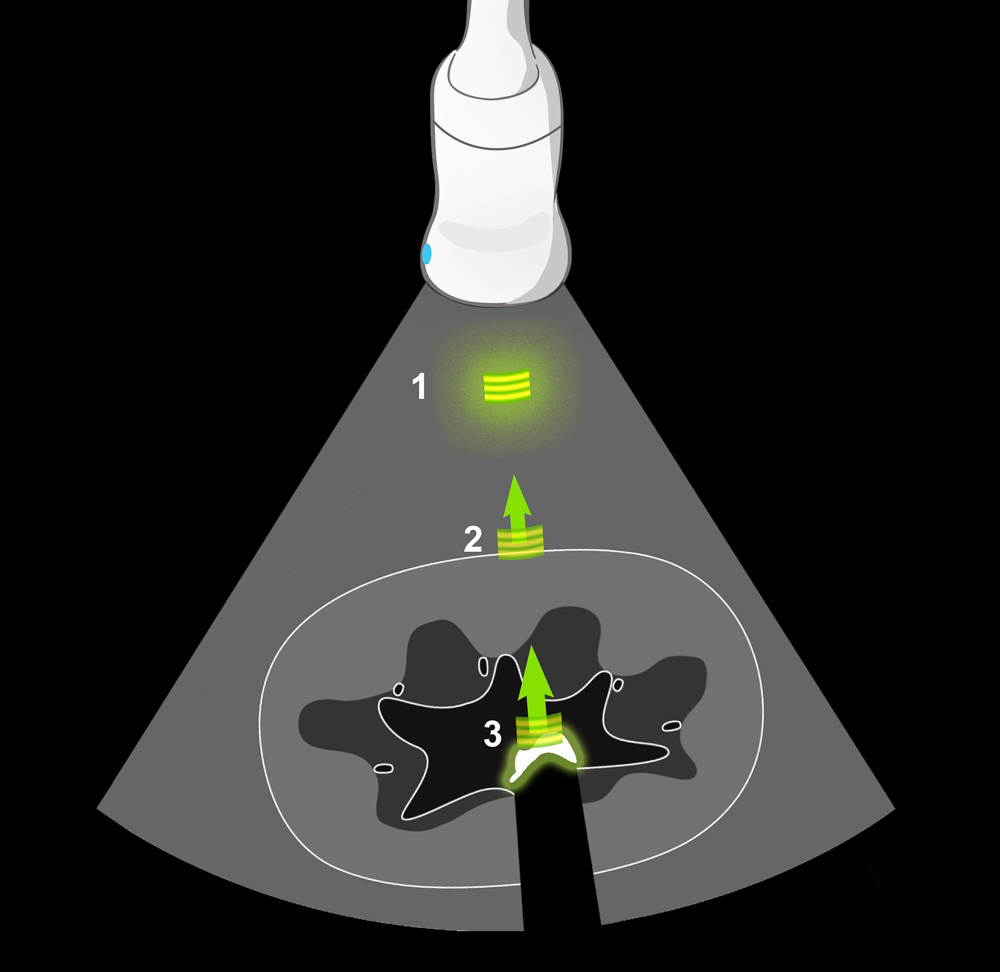 Idiopathic fat necrosis (Bate's body) - Small Animal Ultrasonography