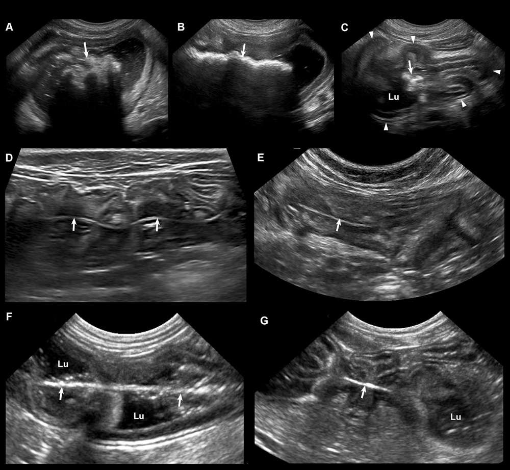 Idiopathic fat necrosis (Bate's body) - Small Animal Ultrasonography